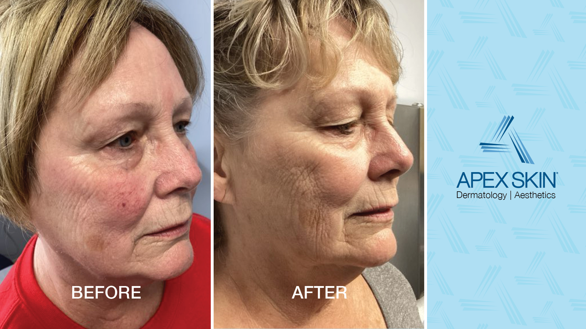 Protect Your Skin from Blue Light | Apex Skin Insights